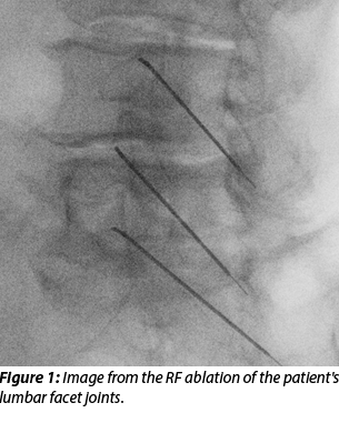 Case Report: Focused Ultrasound for Facetogenic Low Back Pain - Focused ...