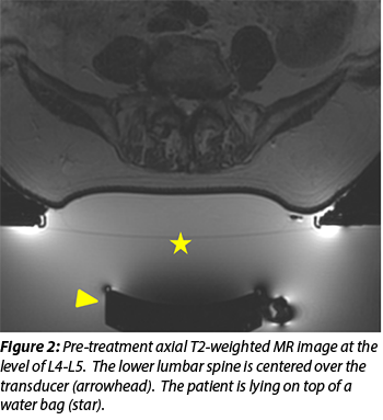 Case Report: Focused Ultrasound for Facetogenic Low Back Pain - Focused ...