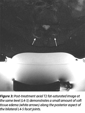 Case Report: Focused Ultrasound for Facetogenic Low Back Pain - Focused ...