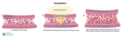Vasodilation - Focused Ultrasound Foundation