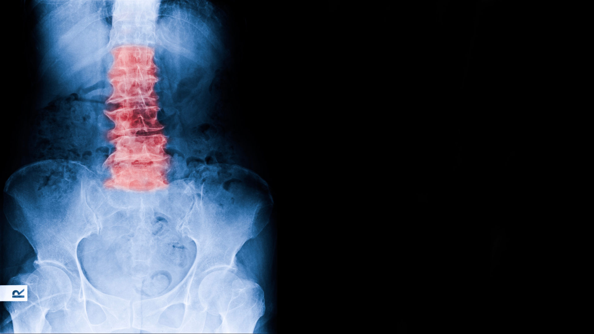 Focused Ultrasound Clinical Trial for Chronic Back Pain Begins ...