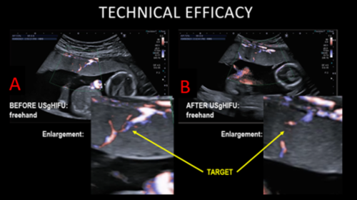 Interim Report: Focused Ultrasound for Twin-Twin Transfusion Syndrome ...