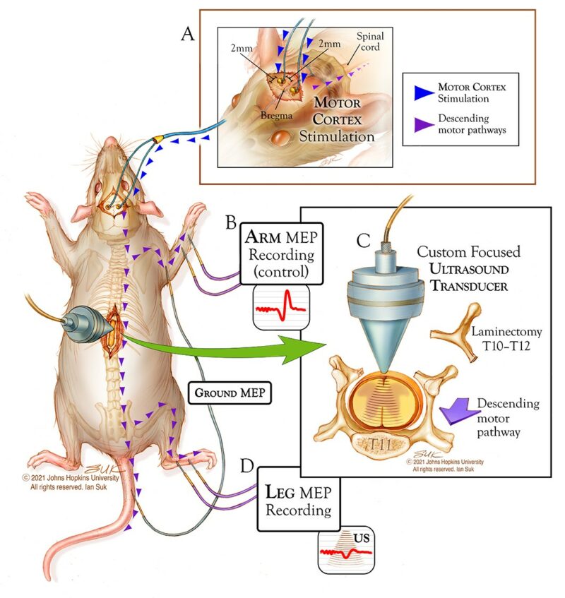 Focused Ultrasound for Motor Neuron Modulation of the Spinal Cord - Focused Ultrasound Foundation