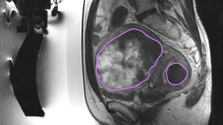 Uterine Fibroid Treatment: New Metric is a Key for Predicting Success ...