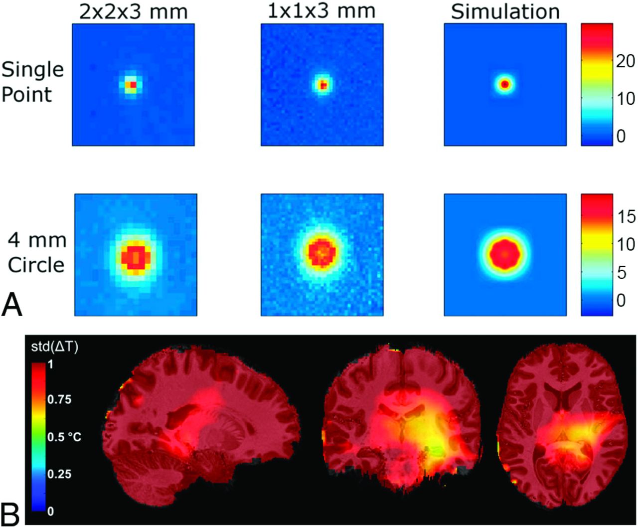 Clinical Review: Focused Ultrasound Brain Treatment Monitoring ...
