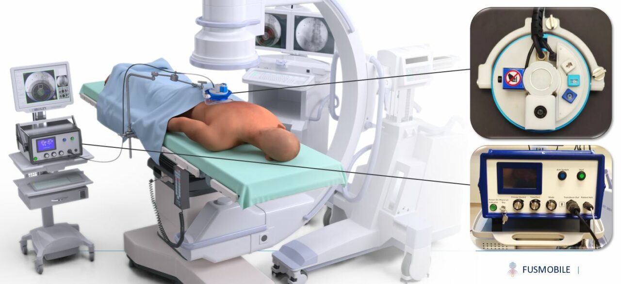 Focused Ultrasound for Low Back Pain: First-of-Its-Kind Device Receives ...