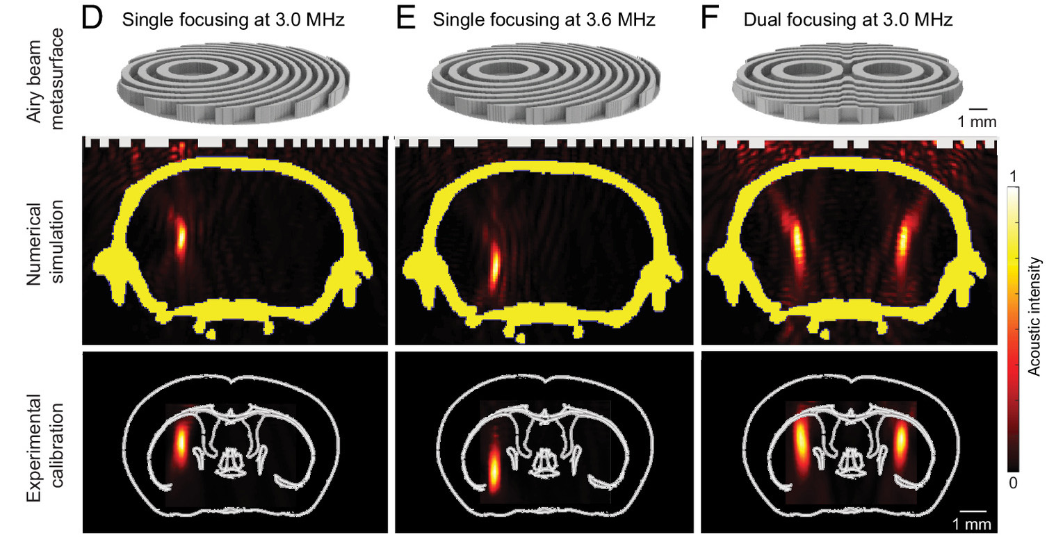 An Innovative Wearable Neuromodulation Device - Focused Ultrasound ...
