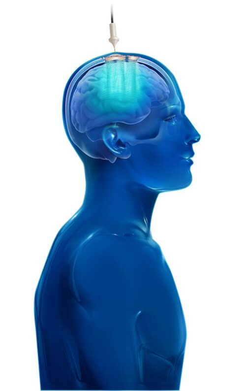 Therapeutic Ultrasound for Recurrent Glioblastoma: A Q&A on Carthera’s ...