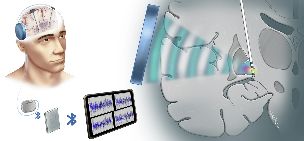 Focused Ultrasound Neuromodulation Clinical Trial: Target Engagement ...