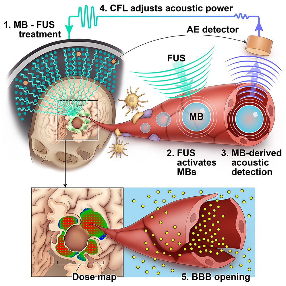 Method Established for Measuring and Predicting Blood-Brain Barrier Opening with Focused ...